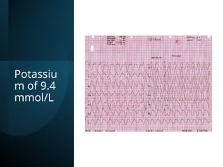 ECG and electrolyte imbalance and interpretation | PPTX