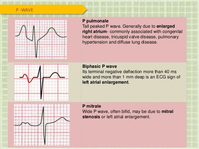 ECG An Introduction
