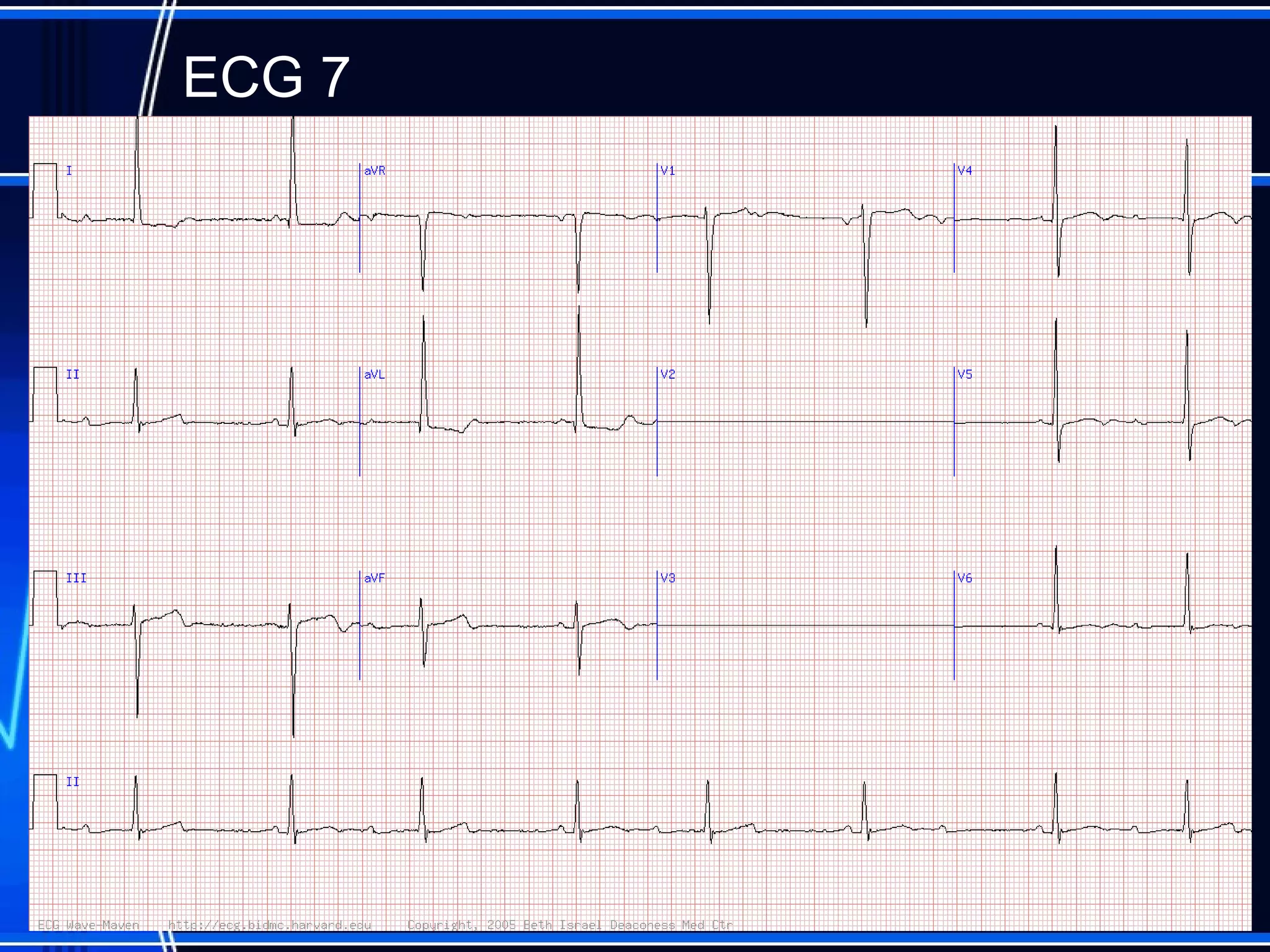 ECG approach to arrhythmias 2017 | PPT | Heart and Cardiovascular ...