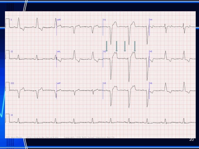 ECG approach to arrhythmias 2017 | PPT | Heart and Cardiovascular ...