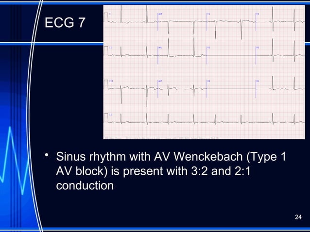ECG approach to arrhythmias 2017 | PPT | Heart and Cardiovascular ...