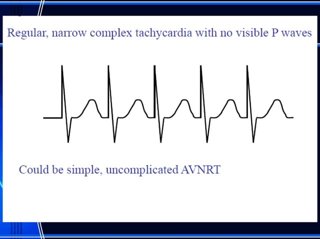 ECG approach to arrhythmias 2017 | PPT | Heart and Cardiovascular ...