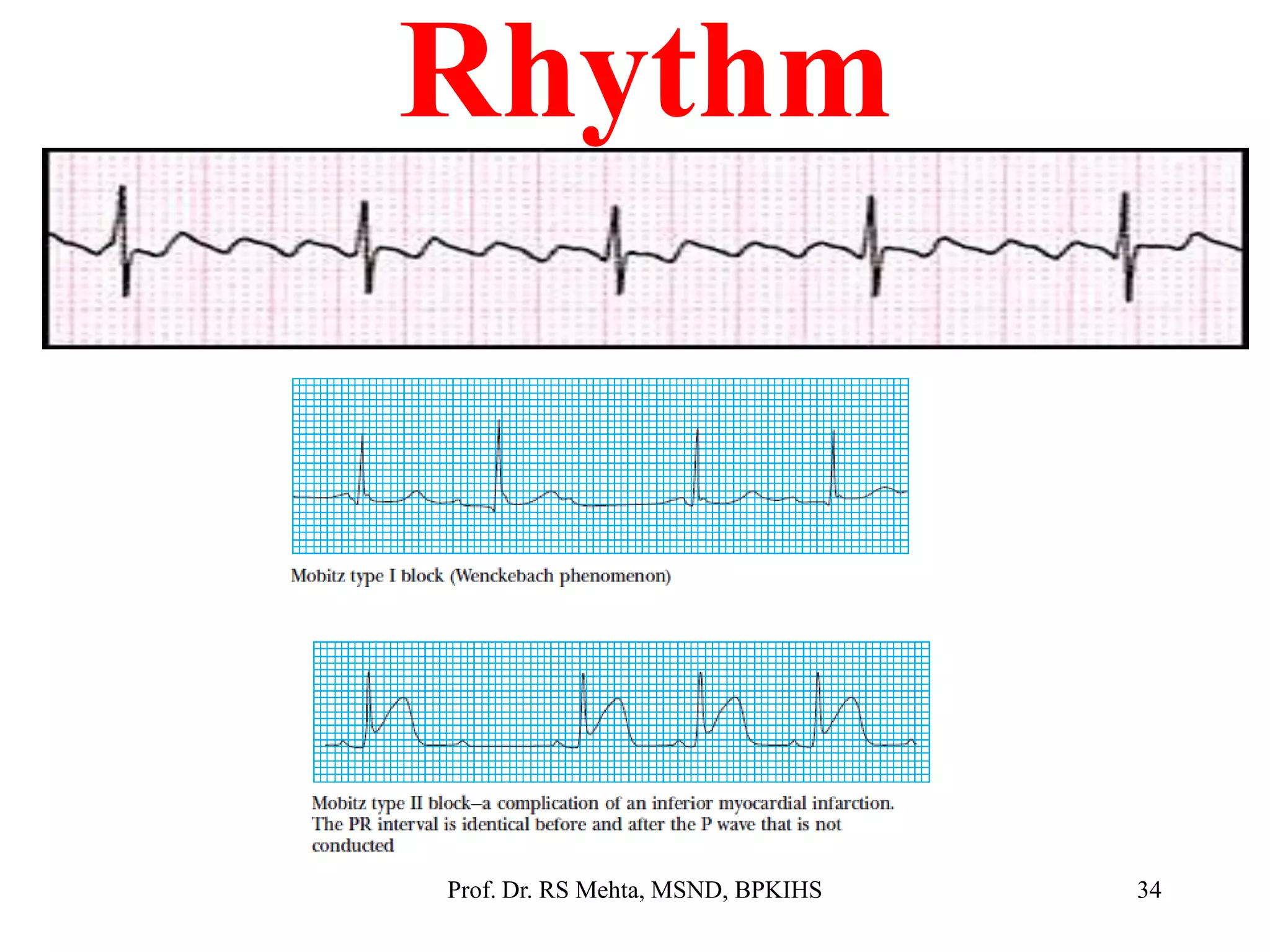Ecg & arrhythmias | PPSX