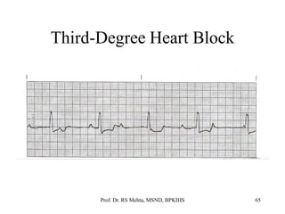 Ecg & arrhythmias | PPSX