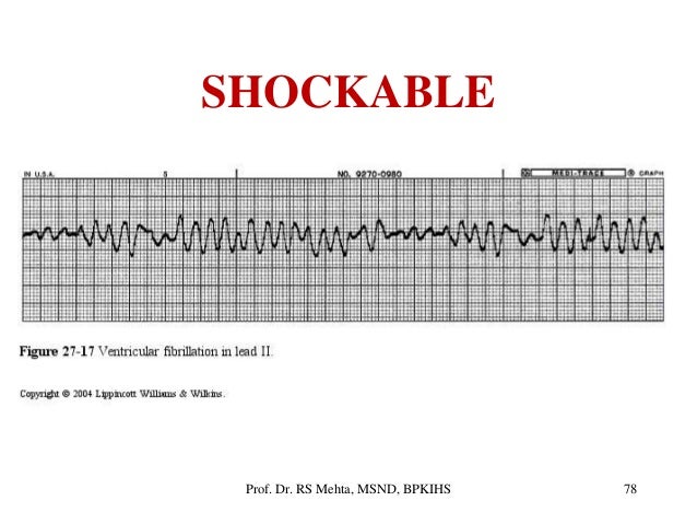 Ecg & arrhythmias