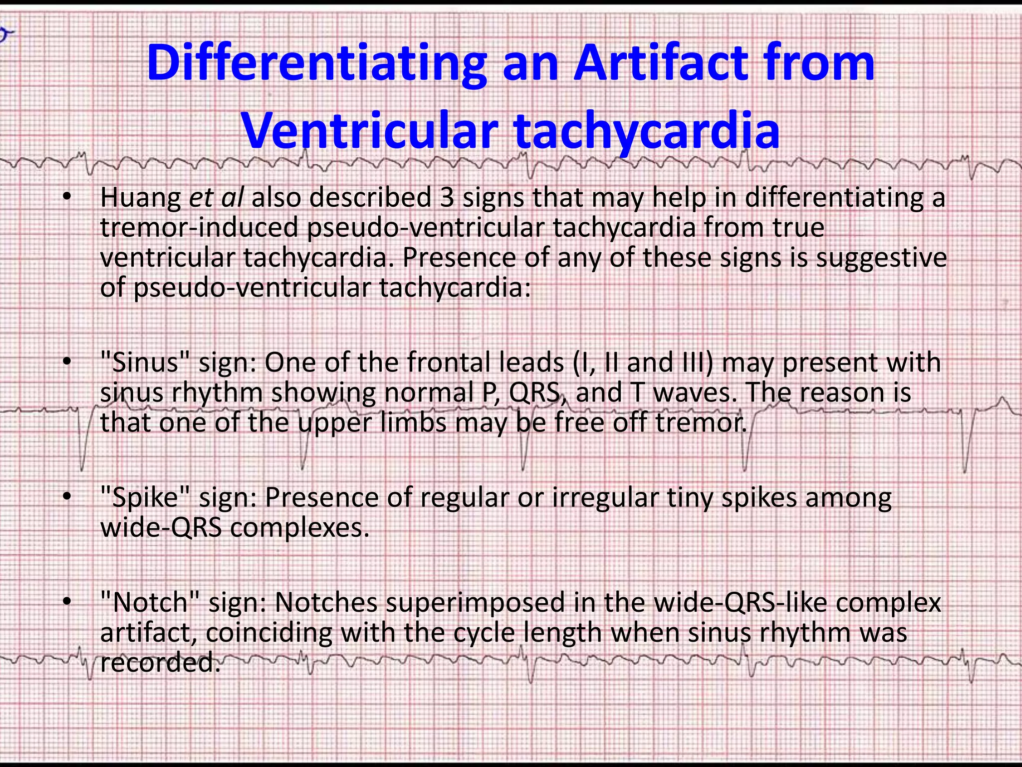 ECG ARTIFACTS AND PITFALLS | PPTX