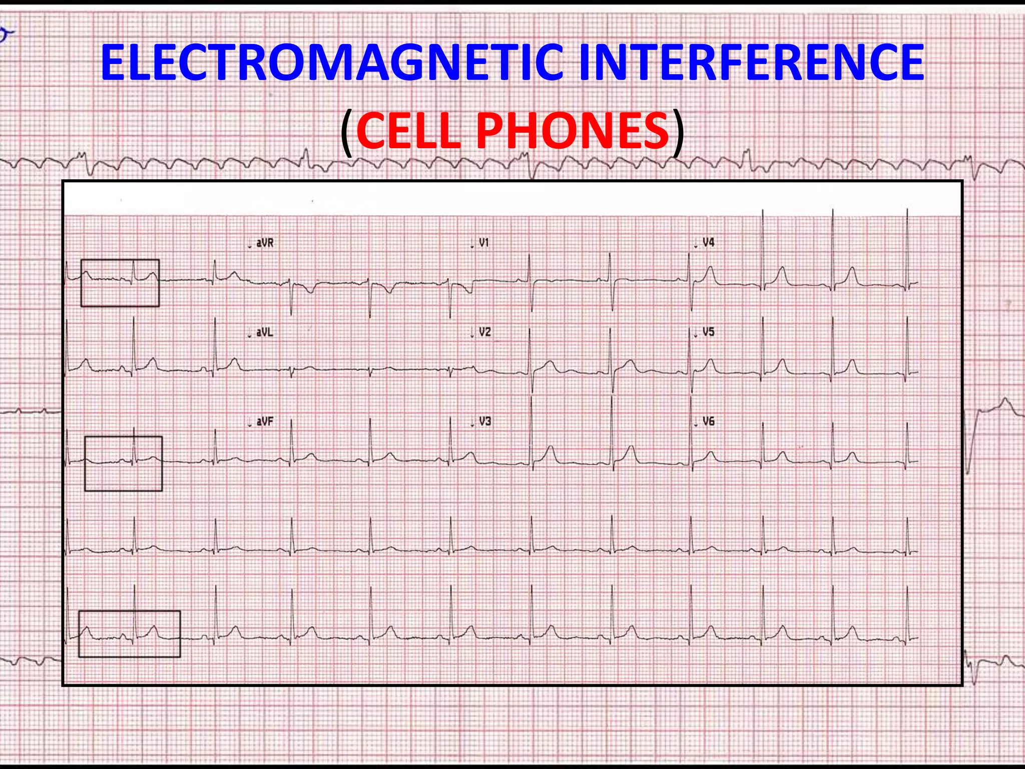 ECG ARTIFACTS AND PITFALLS | PPTX