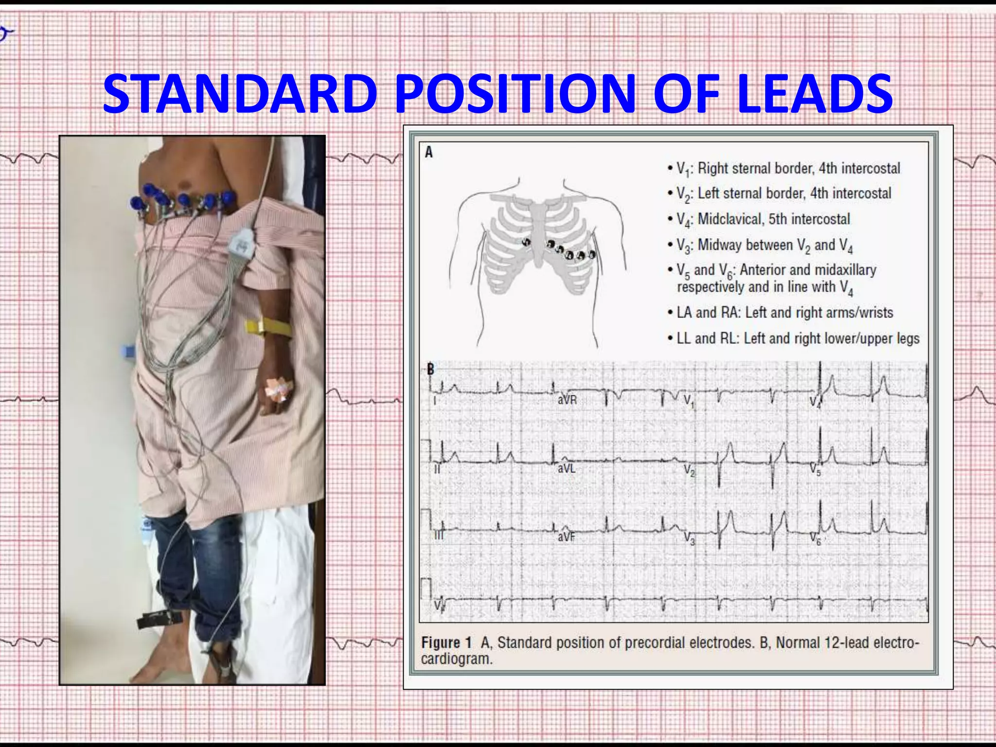 Ecg Artifacts And Pitfalls Pptx