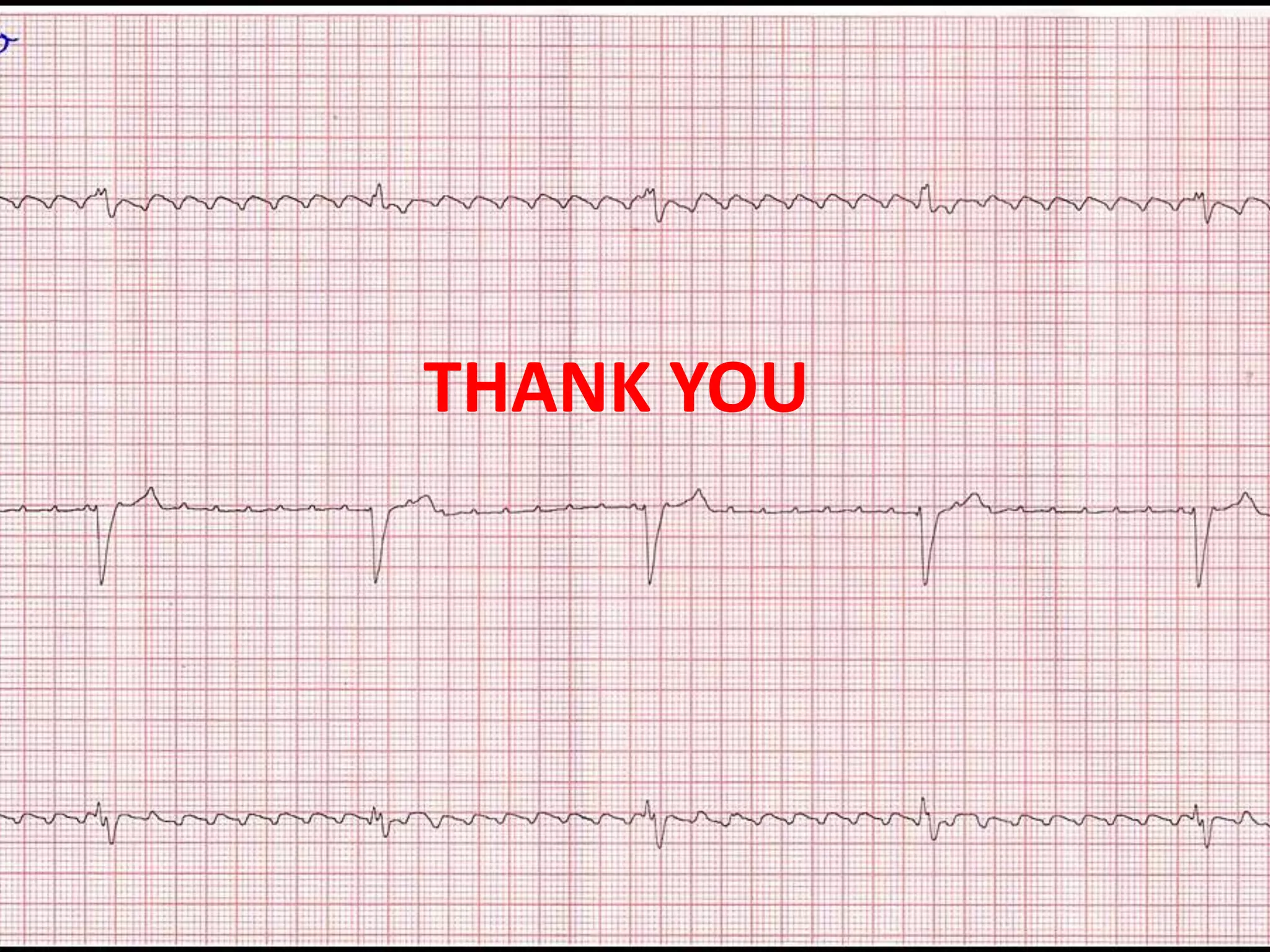 ECG ARTIFACTS AND PITFALLS | PPTX