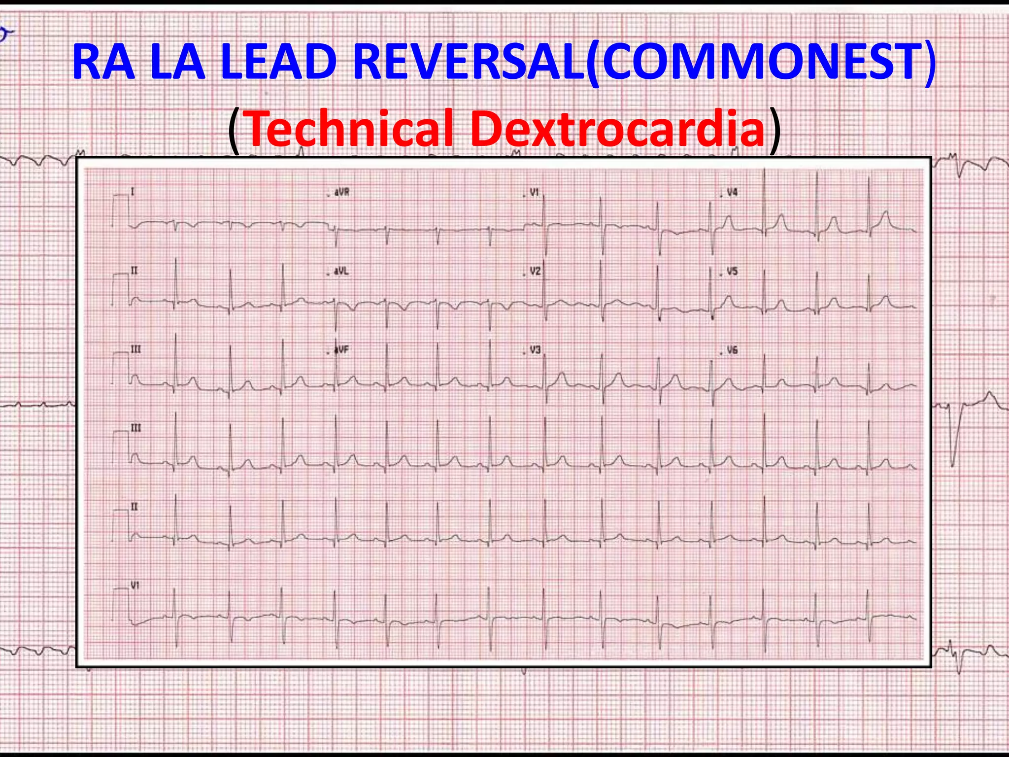ECG ARTIFACTS AND PITFALLS | PPTX