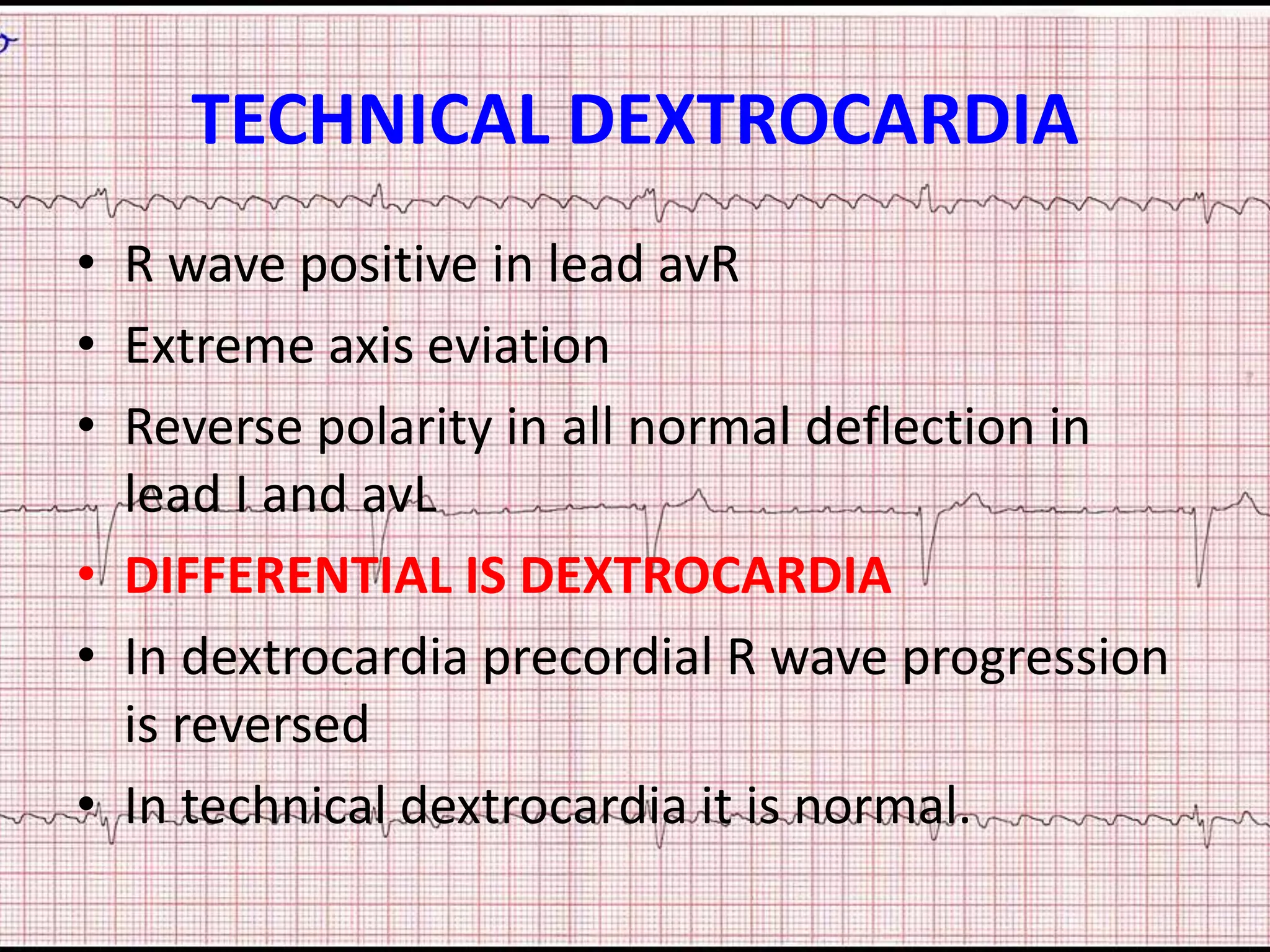 ECG ARTIFACTS AND PITFALLS | PPTX