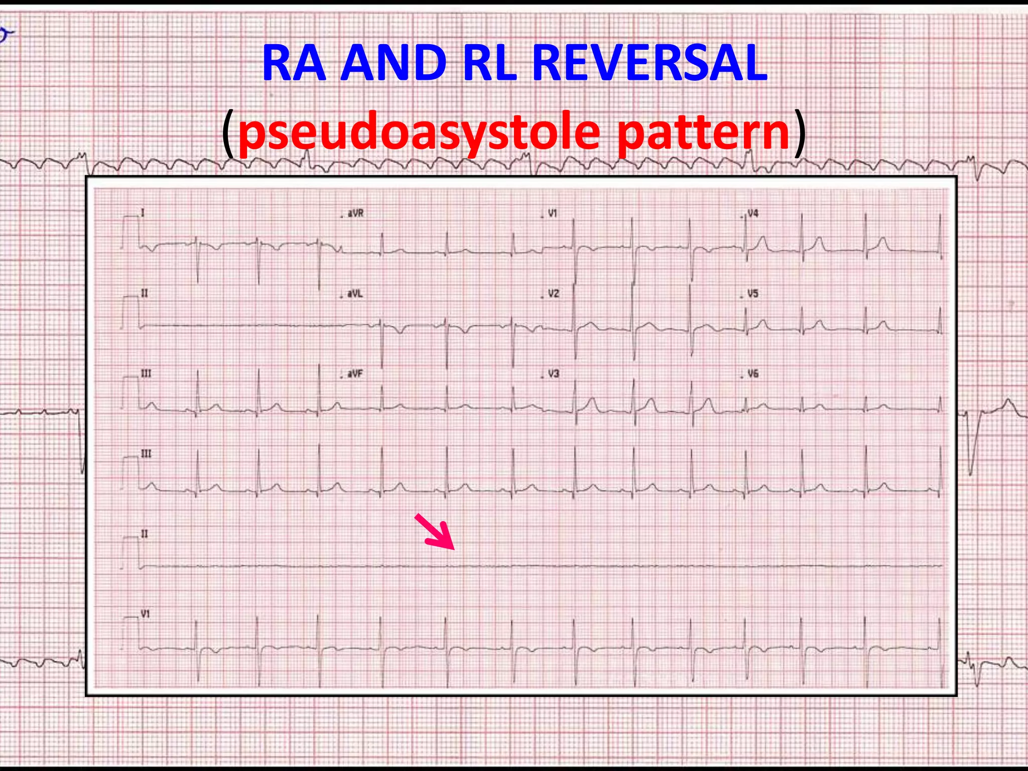 ECG ARTIFACTS AND PITFALLS | PPTX