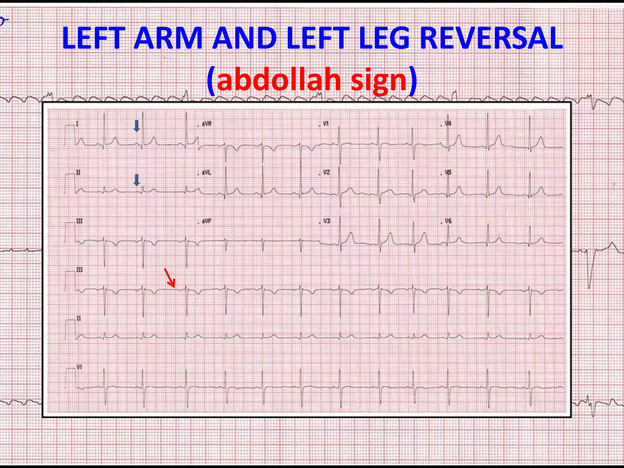 ECG ARTIFACTS AND PITFALLS | PPTX