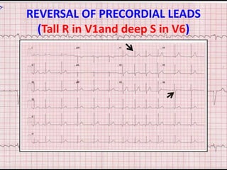 ECG ARTIFACTS AND PITFALLS | PPTX