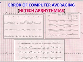 ECG ARTIFACTS AND PITFALLS | PPTX