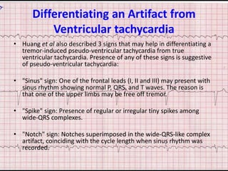 ECG ARTIFACTS AND PITFALLS | PPTX