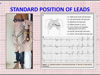 ECG ARTIFACTS AND PITFALLS | PPTX