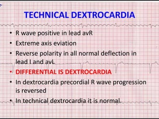 ECG ARTIFACTS AND PITFALLS | PPTX