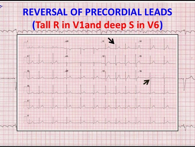 ECG ARTIFACTS AND PITFALLS