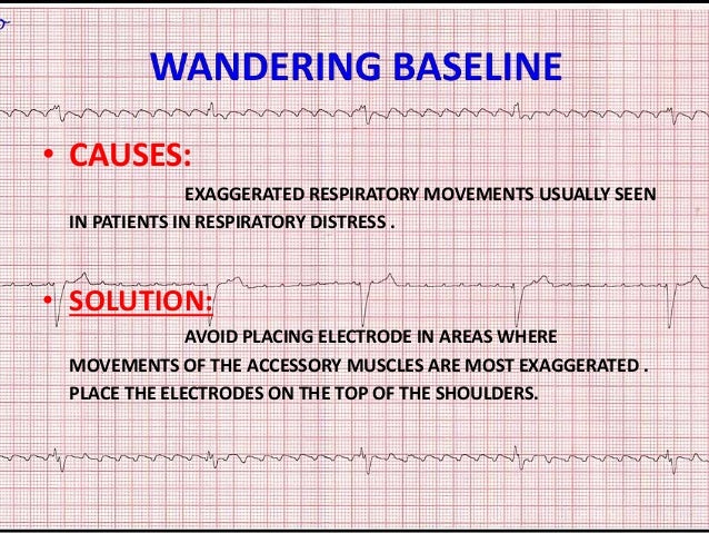ECG ARTIFACTS AND PITFALLS
