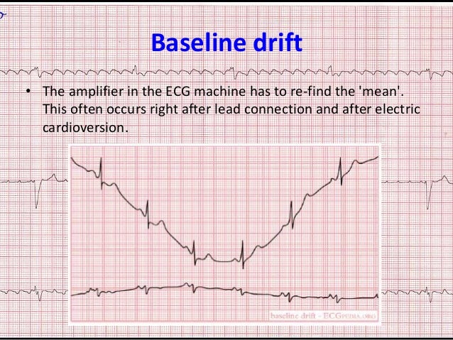 ECG ARTIFACTS AND PITFALLS