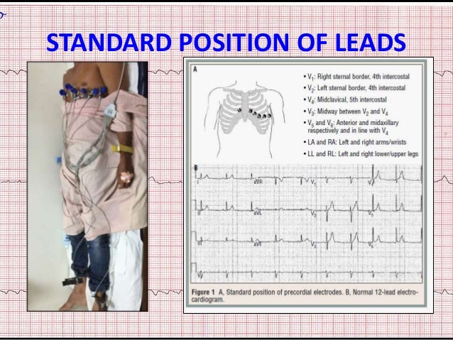 ECG ARTIFACTS AND PITFALLS