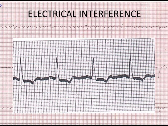 ECG ARTIFACTS AND PITFALLS