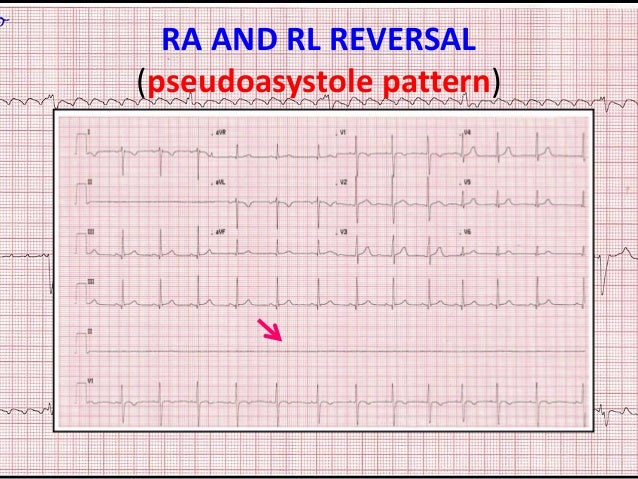 ECG ARTIFACTS AND PITFALLS