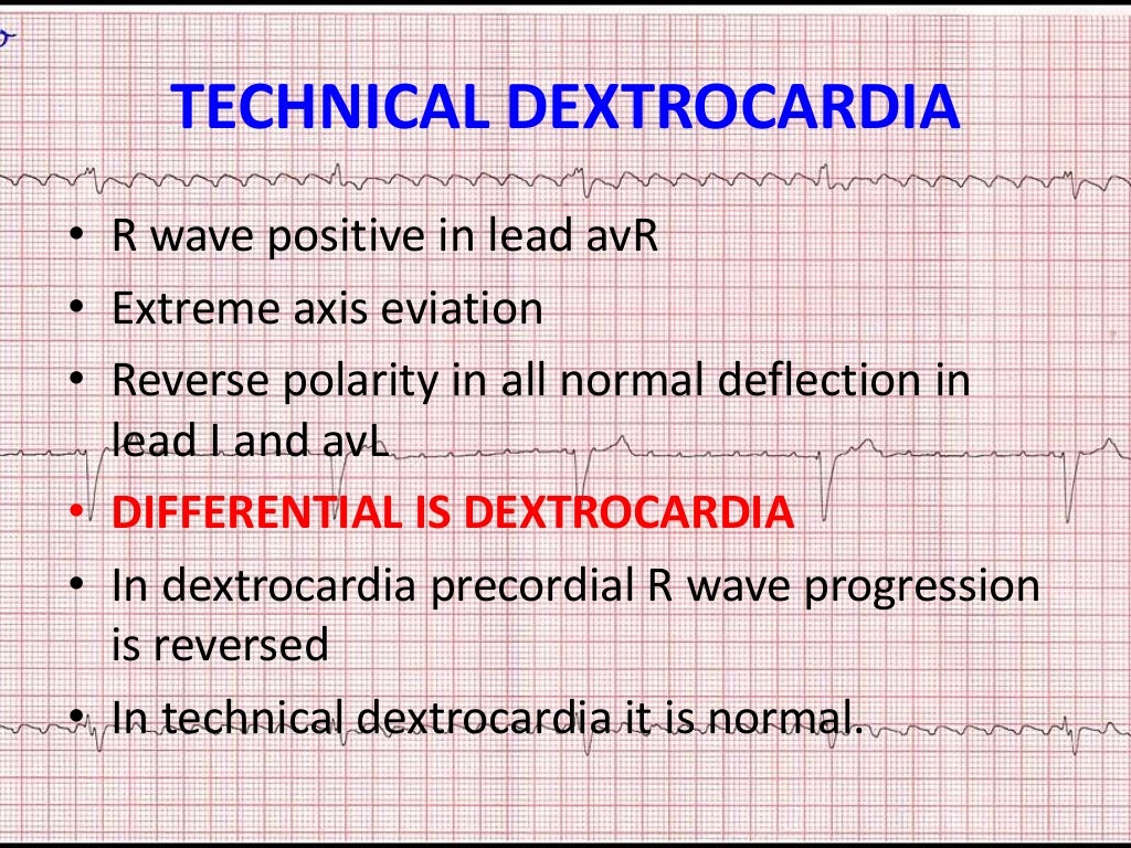 Ecg Artifacts And Pitfalls 