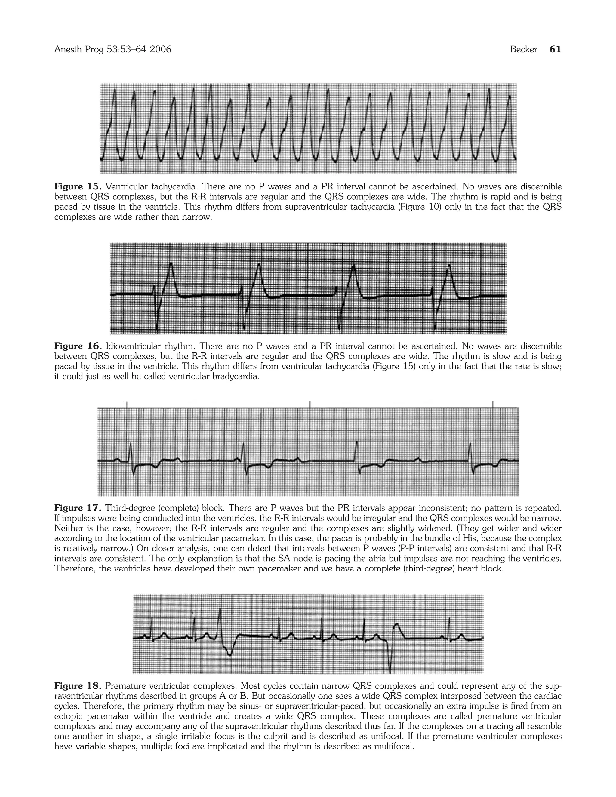 Ecg article | PDF
