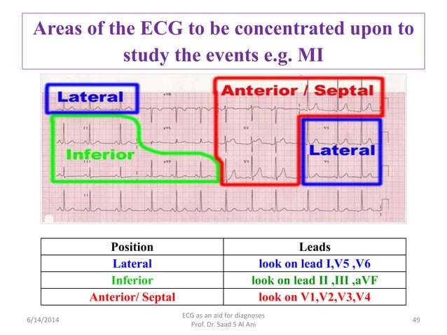 Ecg as an aid for diagnoses | PPT