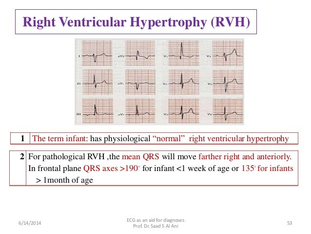 Ecg as an aid for diagnoses