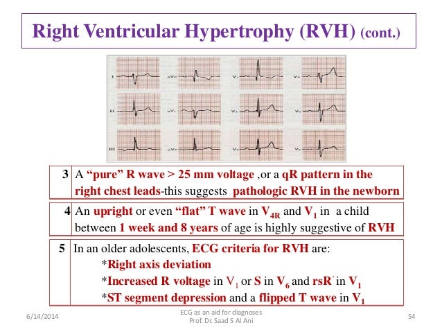 Ecg as an aid for diagnoses