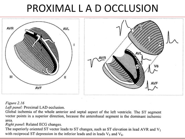 ECG: Interpreting ASMI | PPT | Heart and Cardiovascular Diseases ...