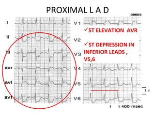 ECG: Interpreting ASMI | PPT