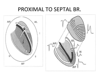 ECG: Interpreting ASMI | PPT