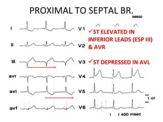 ECG: Interpreting ASMI | PPT