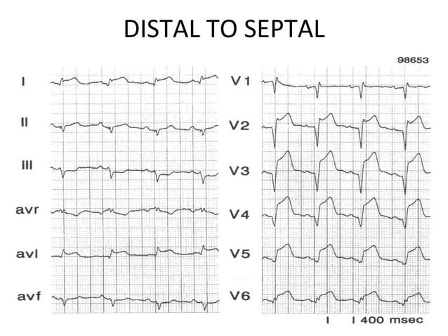 ECG: Interpreting ASMI | PPT | Heart and Cardiovascular Diseases ...