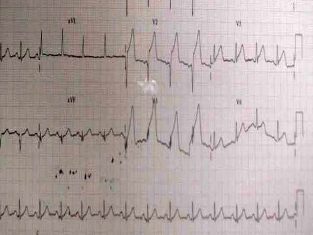 ECG: Interpreting ASMI | PPT | Heart and Cardiovascular Diseases ...