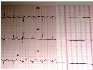 ECG: Interpreting ASMI | PPT