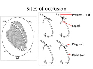 ECG: Interpreting ASMI | PPT