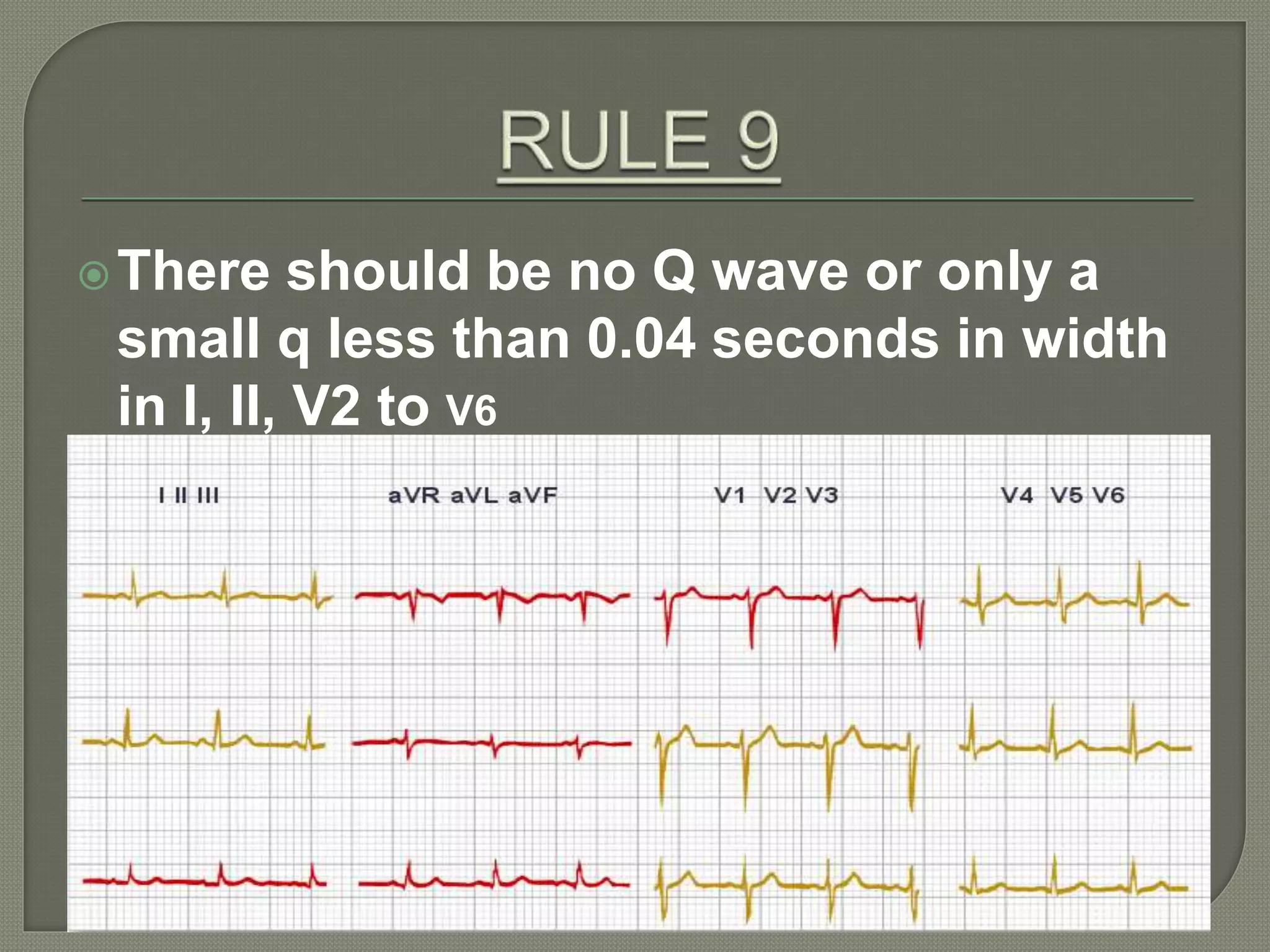 Ecg assessment of ihd | PPTX | Heart and Cardiovascular Diseases ...