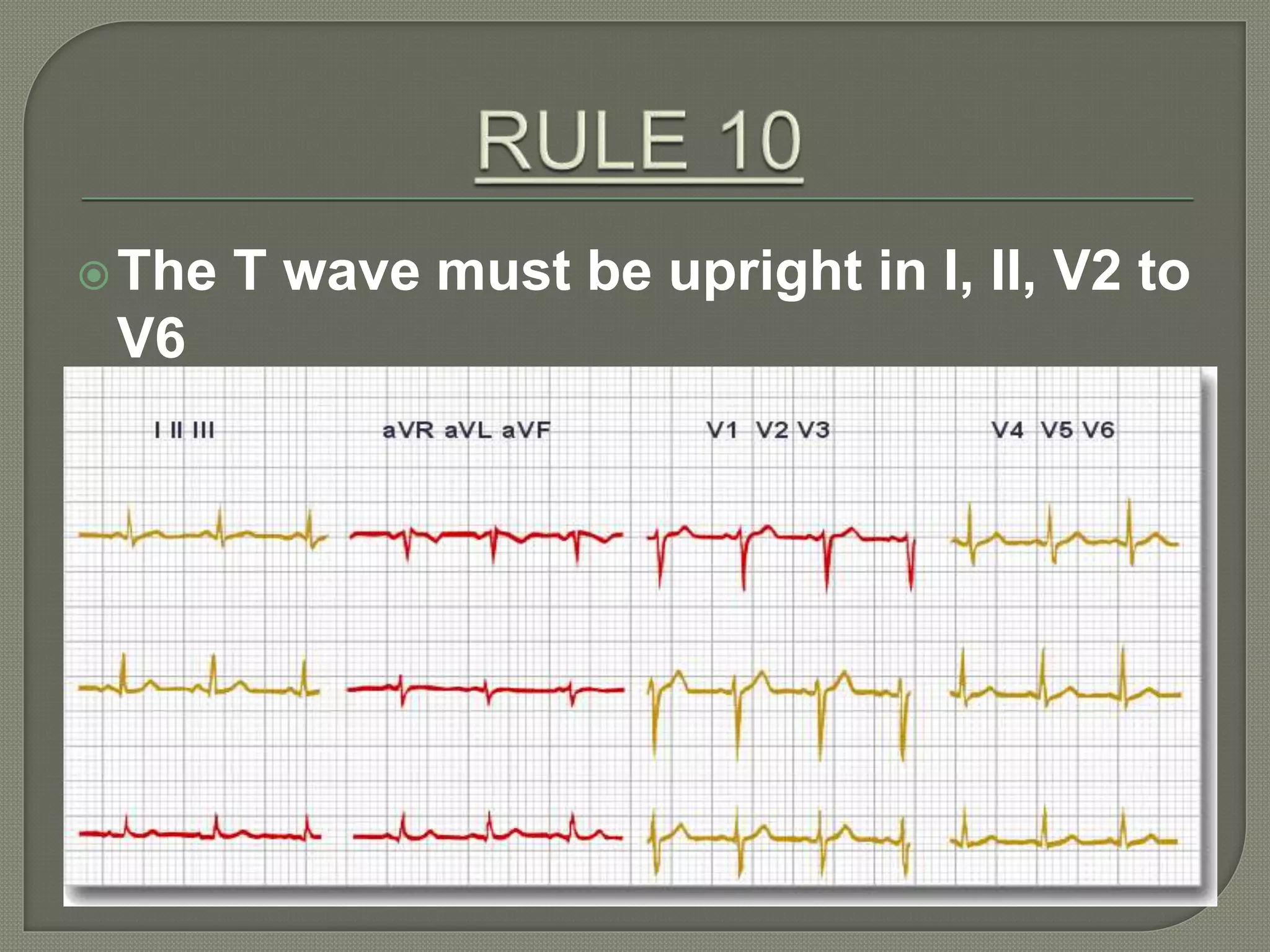 Ecg assessment of ihd | PPTX | Heart and Cardiovascular Diseases ...