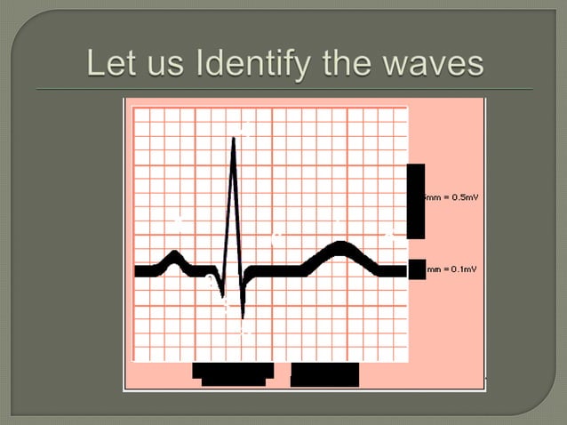 Ecg assessment of ihd | PPTX | Heart and Cardiovascular Diseases ...