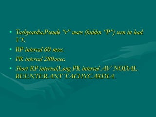 ECG - Narrow complex tachycardia | PPT