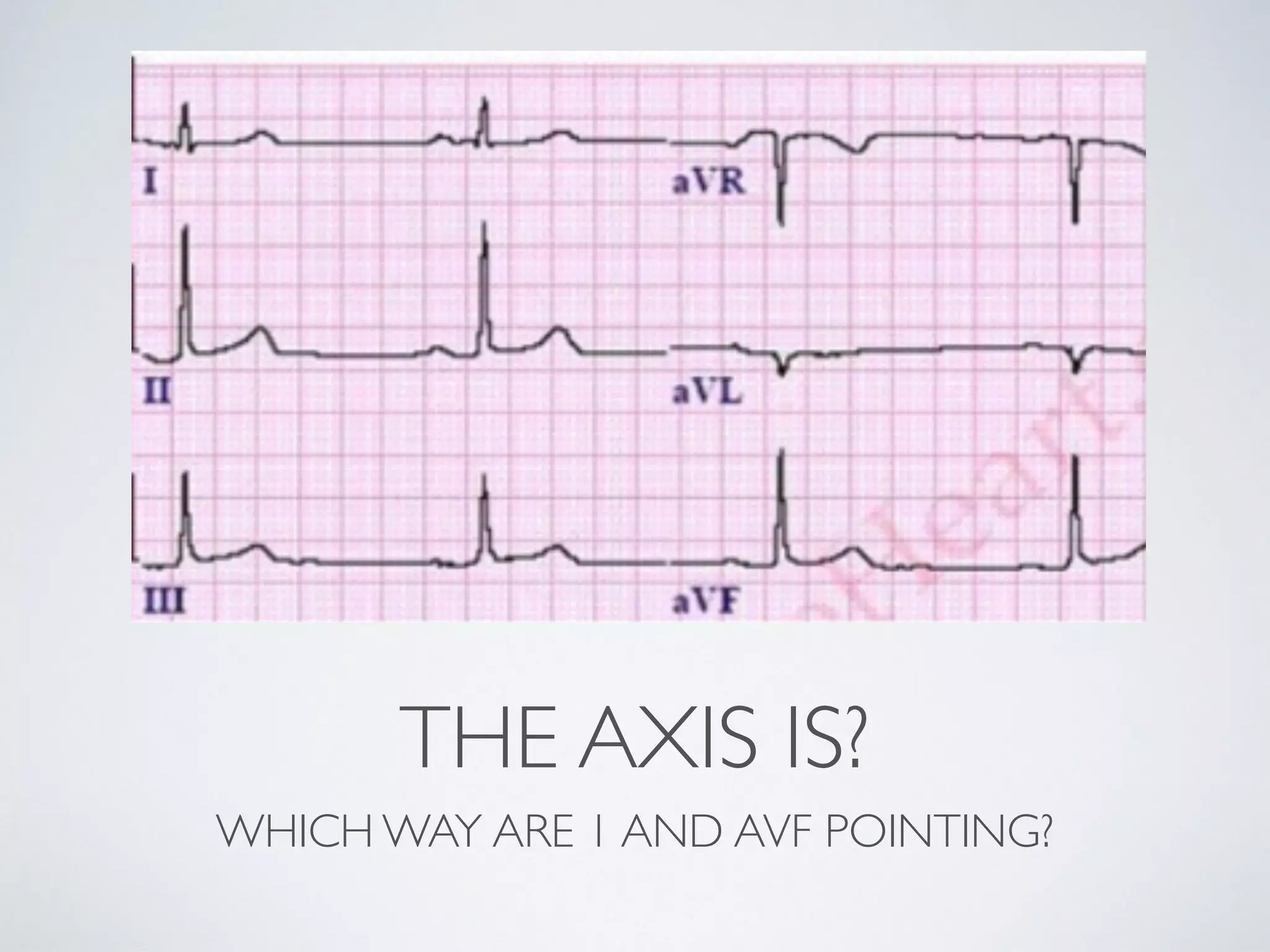 Ecg axis pdf | PDF