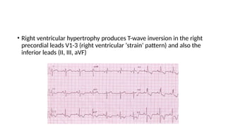 Introduction of ECG, or electrocardiogram | PPTX
