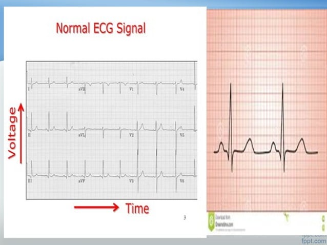 BASICS OF ECG | PPT