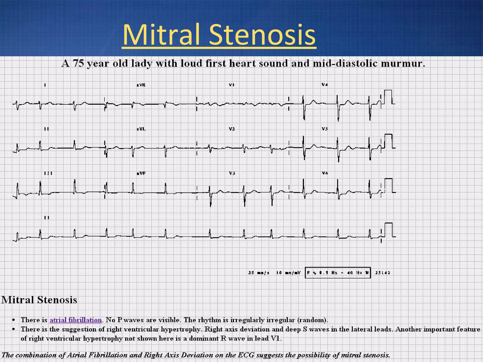 Ecg basic guidelines | PPT