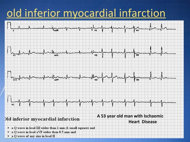 Ecg basic guidelines | PPT